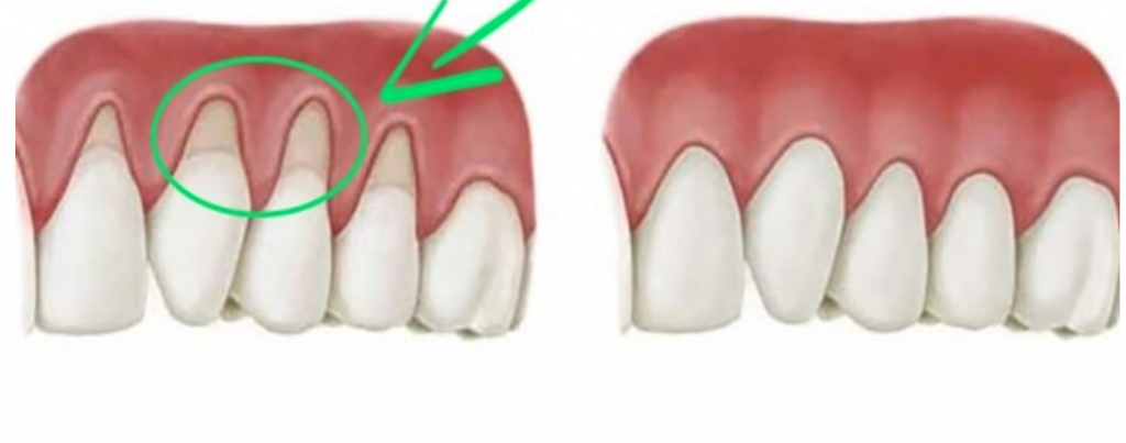 Fai crescere le gengive ritirate con questi rimedi naturali - Donnaweb.net