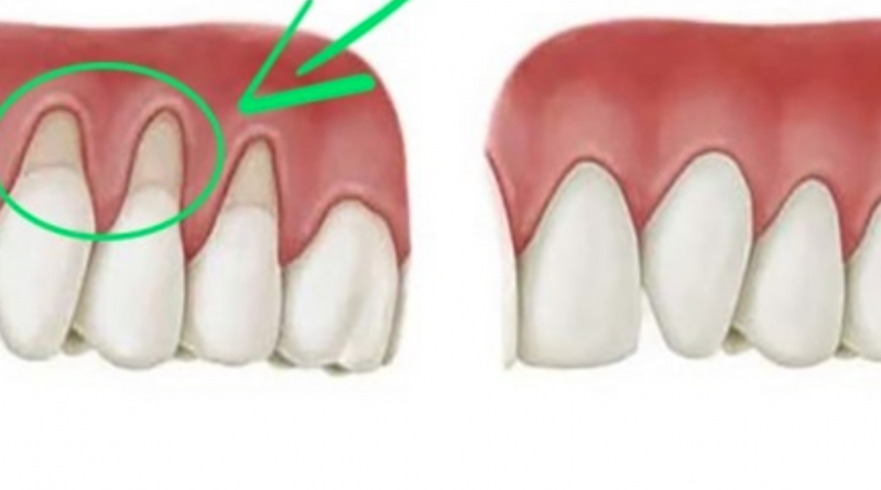 Fai crescere le gengive ritirate con questi rimedi naturali - Donnaweb.net