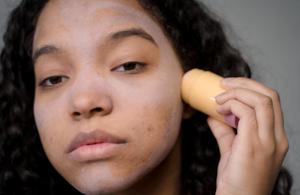 Acne rosacea: si può guarire completamente?